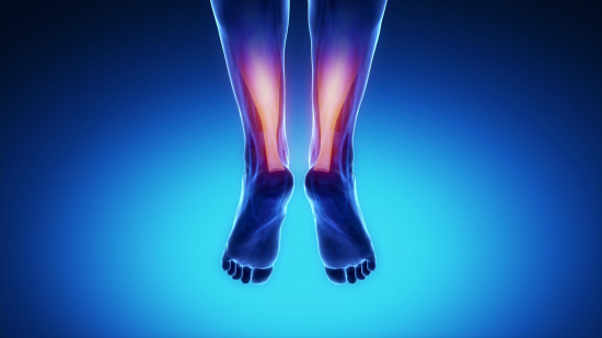 Ruptura del tendón rotuliano con fractura de rotula – Dr. Jose Mario ...