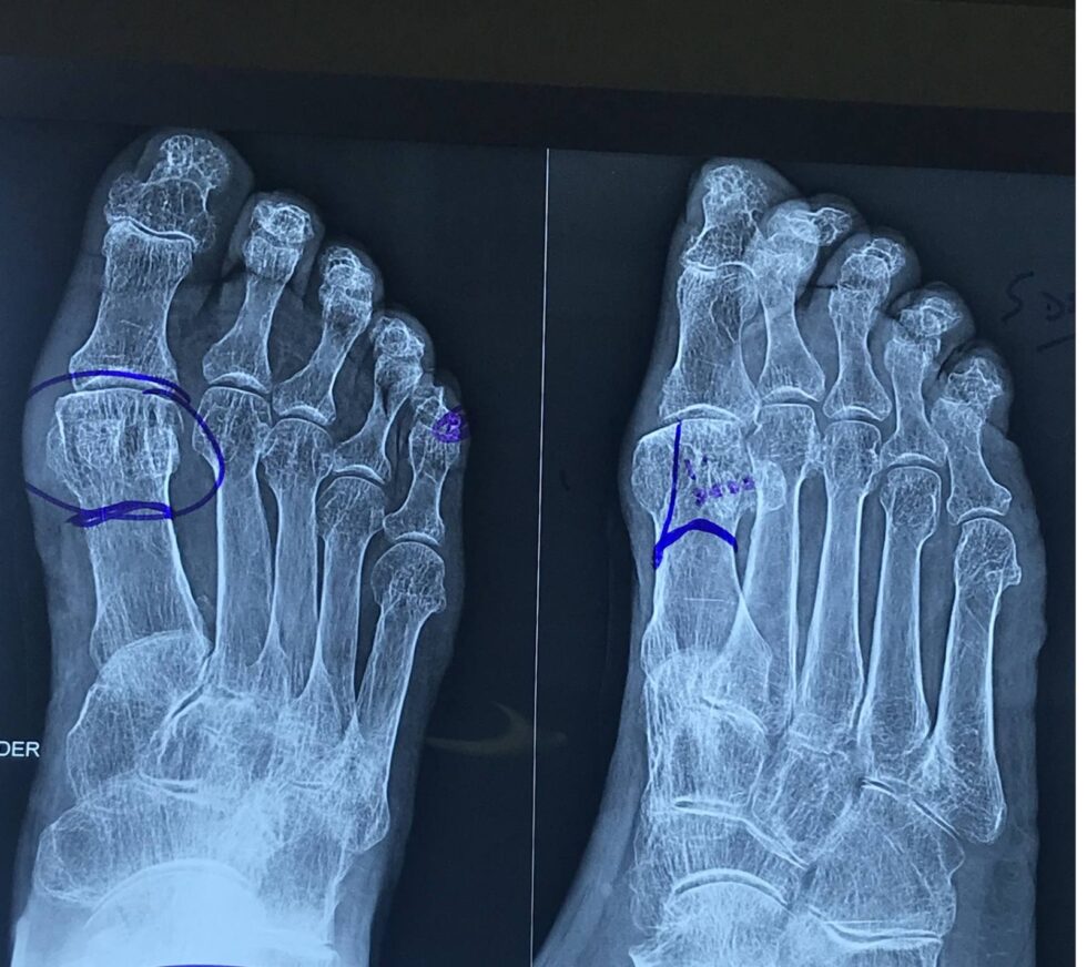 Osteotomía del cuello del primer metatarsiano y resección parcial de la ...