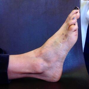 Quintus Varus Suprabductus – Dr. Jose Mario Dorantes Rodríguez ...