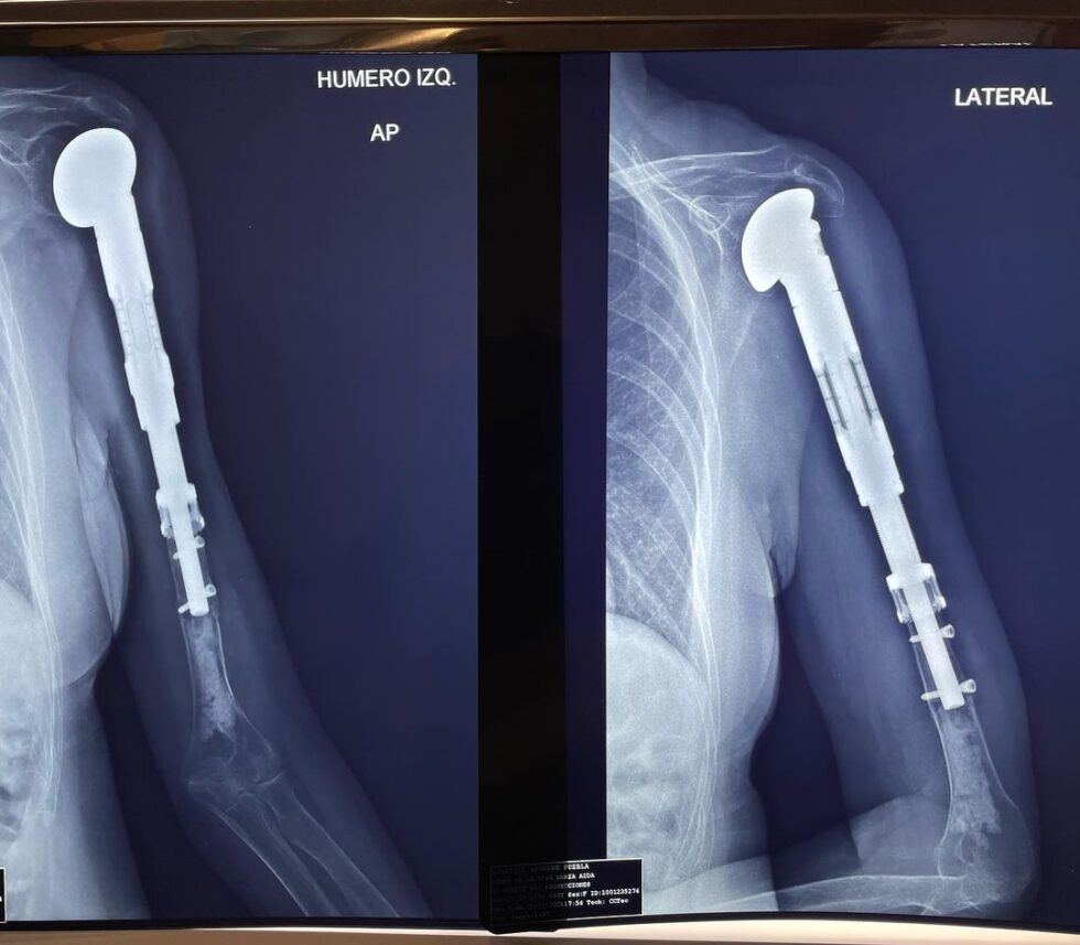 Prótesis Tumoral de húmero izquierdo | Dr. Jose Mario Dorantes ...