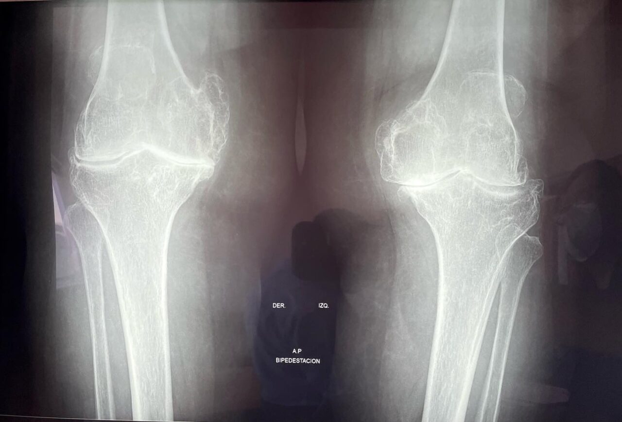 Caso de gonartrosis | Dr. Jose Mario Dorantes Rodríguez, Ortopedista y ...