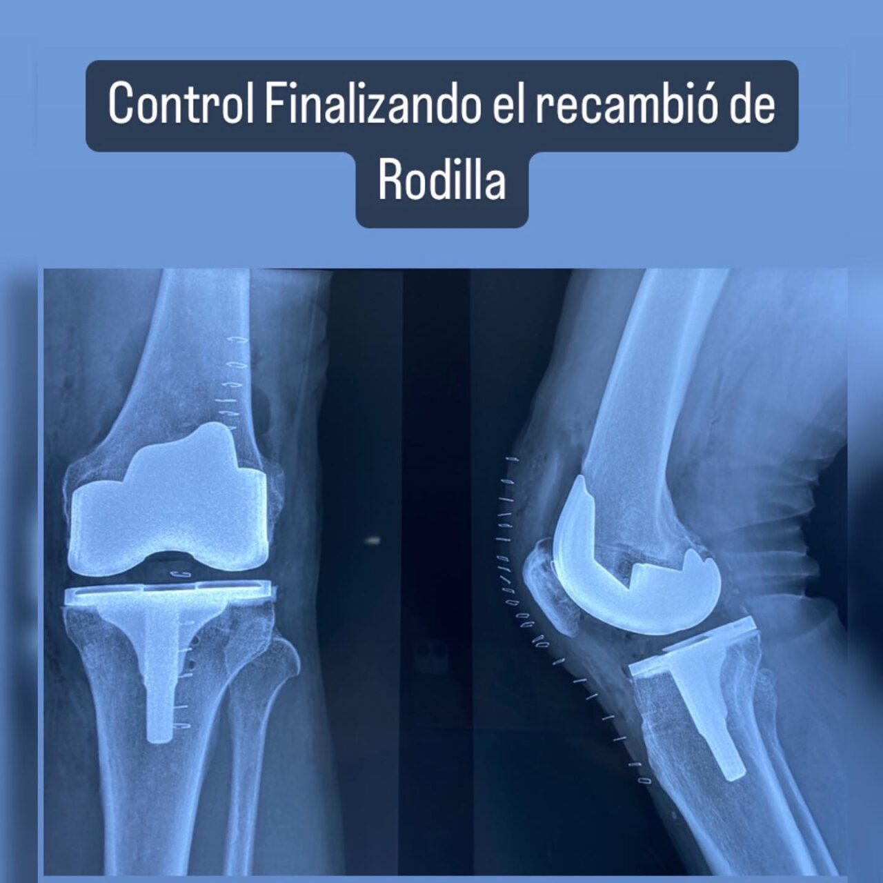 Ortopedia Geriátrica, Cirugía Articular, Prótesis de Rodilla | Dr. Jose ...