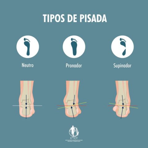 Tipos de pisada | Dr. Jose Mario Dorantes Rodríguez, Ortopedista y ...