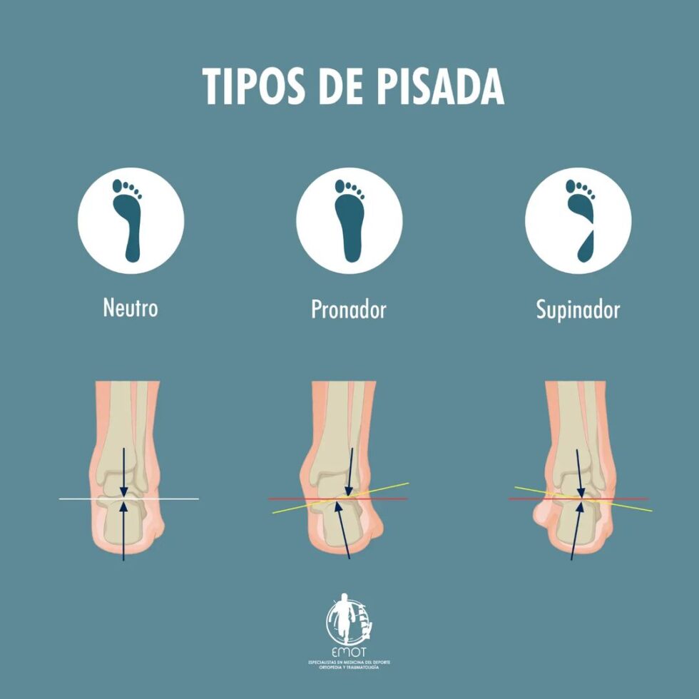 Tipos de pisada | Dr. Jose Mario Dorantes Rodríguez, Ortopedista y ...
