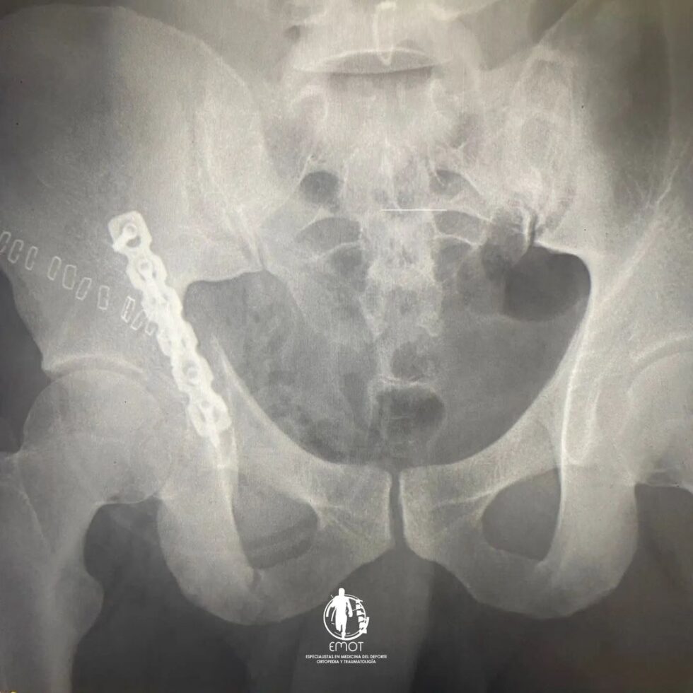 Paciente con fractura de pelvis inestable | Dr. Jose Mario Dorantes ...