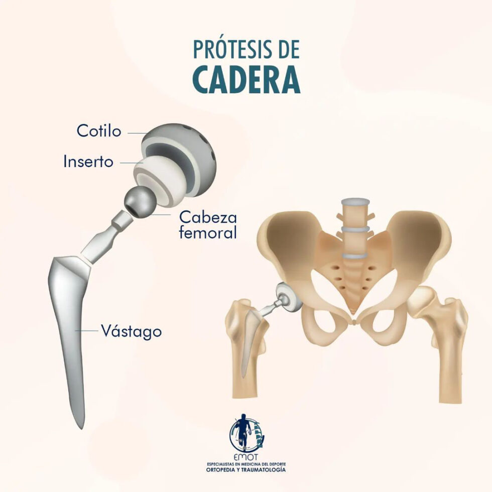 Prótesis de cadera | Dr. Jose Mario Dorantes Rodríguez, Ortopedista y ...