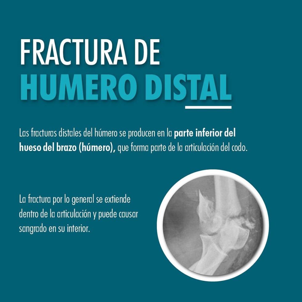Factura de Humero Distal | Dr. Jose Mario Dorantes Rodríguez ...