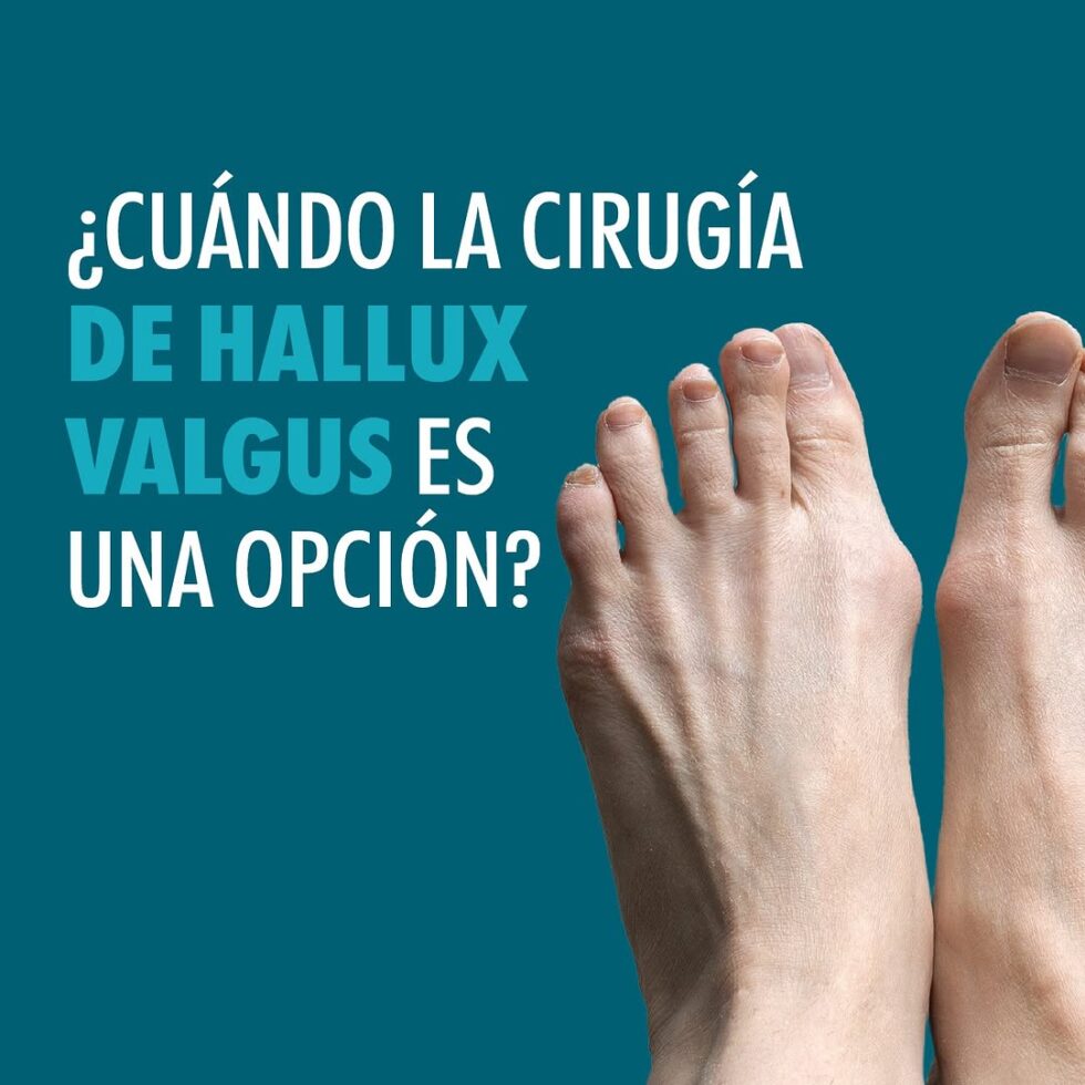 ¿Cuándo la cirugía de Hallux Valgus es una opción? | Dr. Jose Mario ...