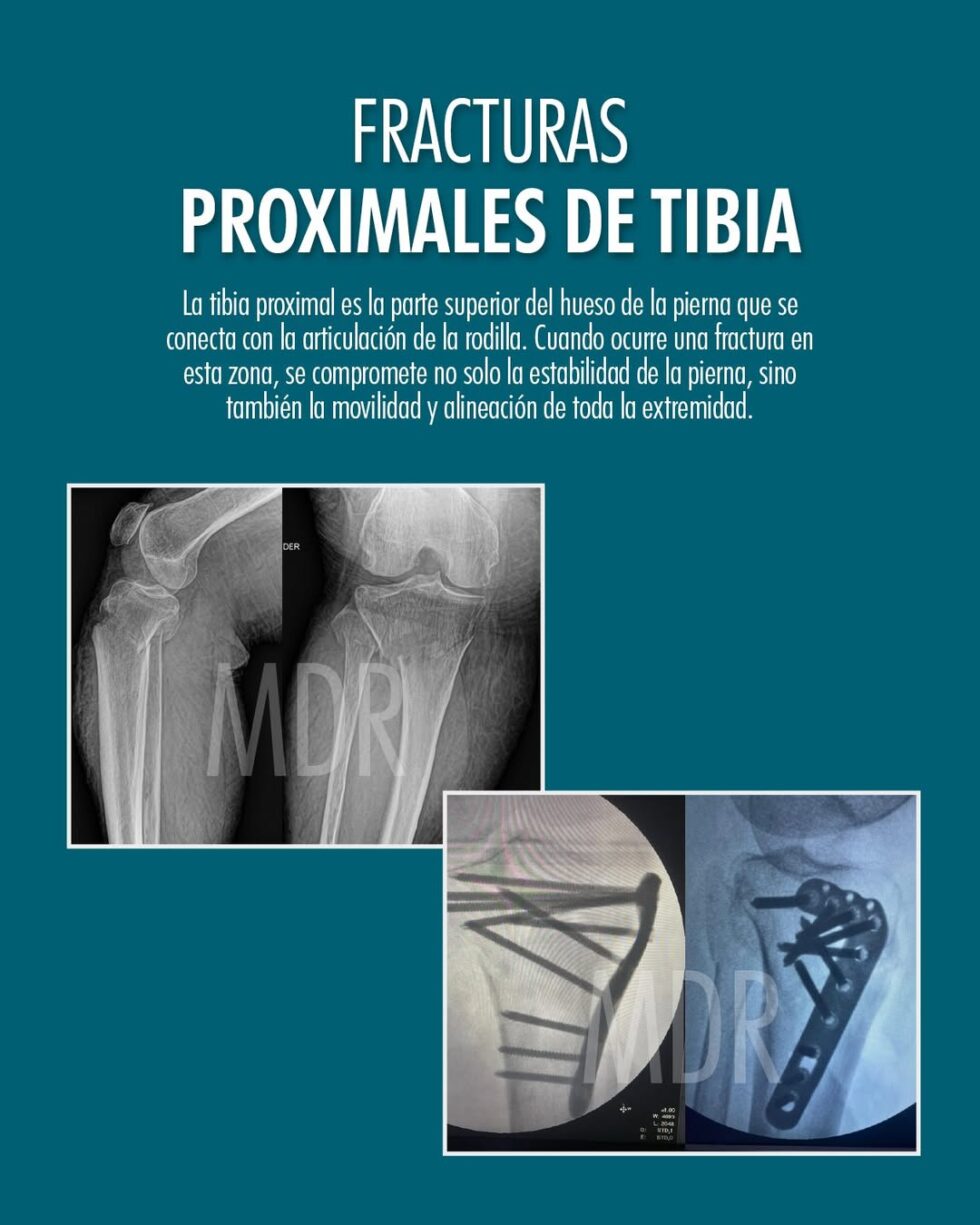 Fracturas Proximales de Tibia | Dr. Jose Mario Dorantes Rodríguez ...